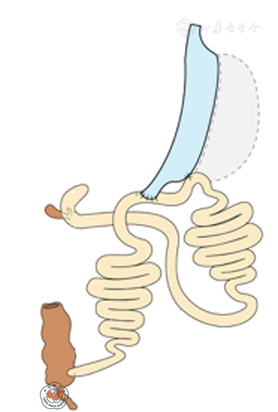 关于单吻合口十二指肠转位手术（SADI-S/SIPS）的立场声明